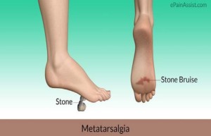 Metatarsalgia (Pain on the Ball of the Foot) - Coquitlam Podiatry
